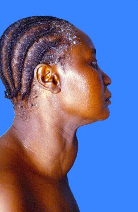 Patient Has Multinodular Goitre Swelling Neck Editorial Stock Photo ...