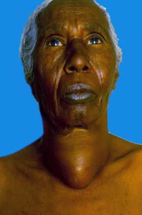 Patient Has Multinodular Goitre Swelling Neck Editorial Stock Photo ...