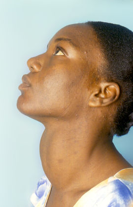 Patient Has Multinodular Goitre Swelling Neck - Foto de stock de ...