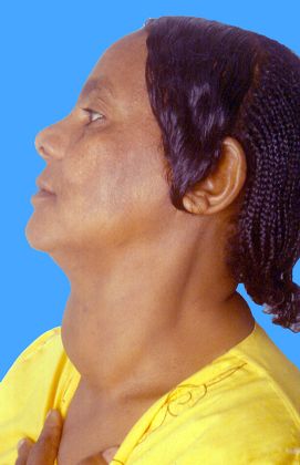 Woman Suffering Enlarged Goitre Editorial Stock Photo - Stock Image ...