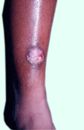 Patient Has Infected Venous Leg Ulcer Editorial Stock Photo - Stock ...