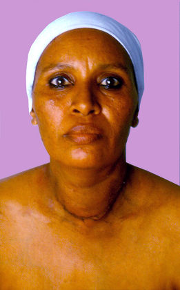 Patient Recovering Thyroidectomy Surgical Removal All Editorial Stock ...