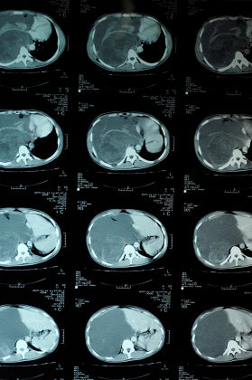 Model Released Ct Scan Showing Blood Editorial Stock Photo - Stock ...