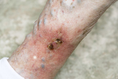 Varicose Ulcers Situated On Ruptured Varicose Editorial Stock Photo ...