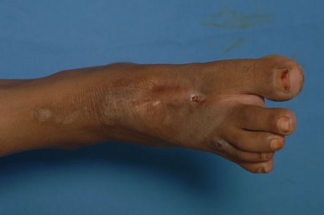 Mycetoma On Right Right Foot Patient Editorial Stock Photo - Stock ...