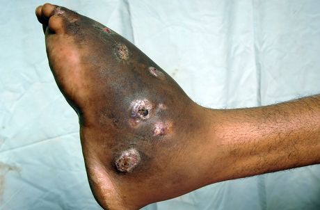 Close Mycetoma On Left Foot Young Editorial Stock Photo - Stock Image ...