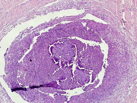 Microscopic Image Mycetoma Mycetoma Disease That Editorial Stock Photo ...
