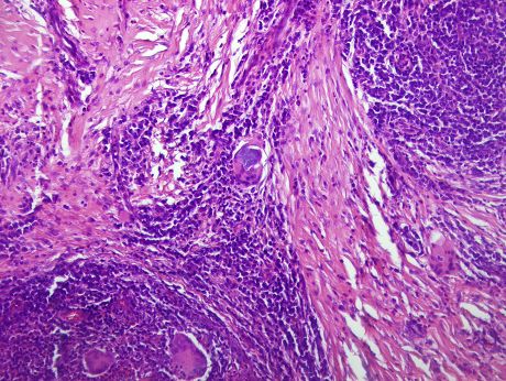 Microscopic Image Mycetoma Mycetoma Disease That Editorial Stock Photo ...