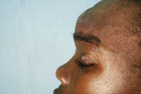 19 Year Old Boy Arteriovenous Malformation Editorial Stock Photo ...