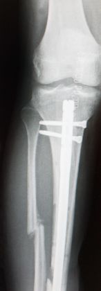 Xray Right Leg Support Pins Following Editorial Stock Photo - Stock ...