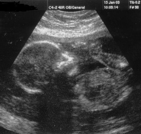 12 Week Ultrasound Scan Foetus Editorial Stock Photo - Stock Image ...