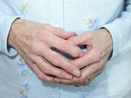 21 Arthritic disease Stock Pictures, Editorial Images and Stock Photos ...