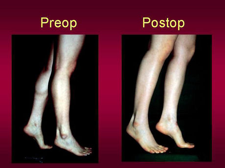 Example Calf Reduction Surgery Pre Operation Editorial Stock Photo ...