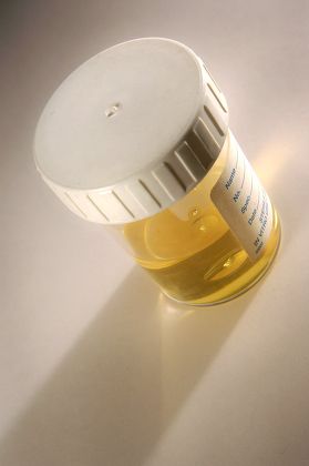 Medical Urine Sample Bottle Editorial Stock Photo - Stock Image ...