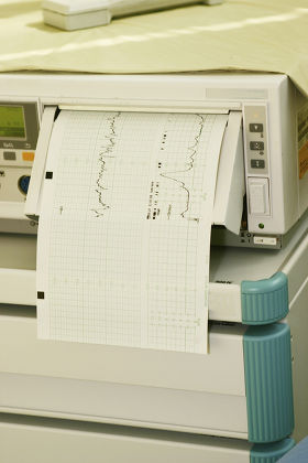 Cardiotocograph Ctg Heart Sound Chart Unborn Editorial Stock Photo ...