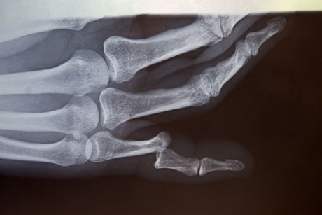 X-RAY BONES HUMAN HAND DISLOCATED LITTLE Editorial Stock Photo - Stock ...