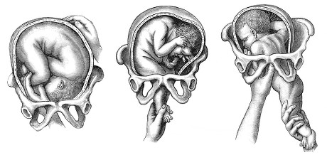 Parturition Various Positions During Childbirth 19th Editorial Stock ...