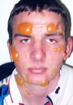 9 Blister gas Stock Pictures, Editorial Images and Stock Photos ...