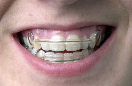 Model Released Brace Retainer Editorial Stock Photo - Stock Image ...