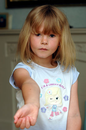 Burn Mark On Emilys Arm Violent Editorial Stock Photo - Stock Image ...