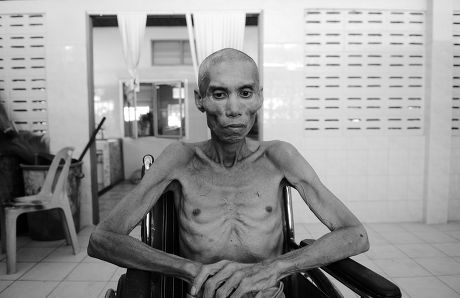 Unclaimed Body Aids Victim Lies Sweating Editorial Stock Photo - Stock ...