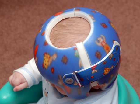 Model Released Baby Undergoing Cranial Remoulding Editorial Stock Photo ...