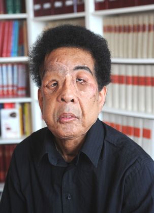 Elephant Man first disease sufferer to receive Face Transplant, Paris ...