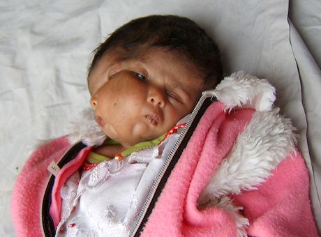 A baby born with two faces in Sani, near New Dehli, India - 03 Apr 2008 ...