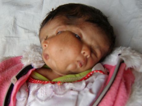 Baby Lali Who Born Two Faces Editorial Stock Photo - Stock Image ...
