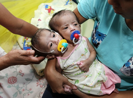 Filipino Conjoined Twins Nicolle L Anne Editorial Stock Photo - Stock ...