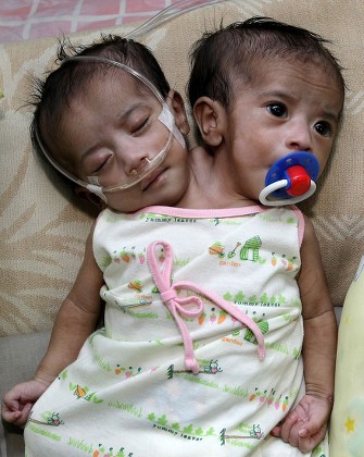 Filipino Conjoined Twins Nicolle L Anne Editorial Stock Photo - Stock ...