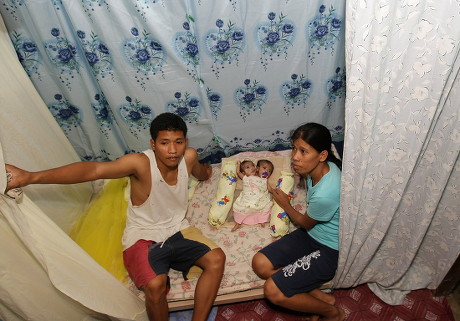 Filipino Conjoined Twins Nicolle 2l Anne Editorial Stock Photo - Stock ...