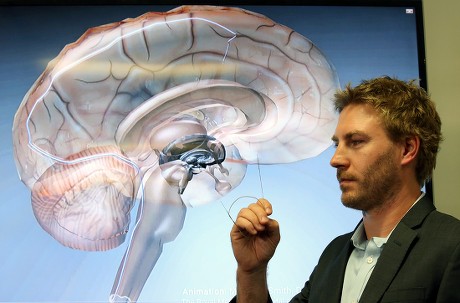 Dr Nicholas Opie Holds Stentbased Electrode Editorial Stock Photo ...