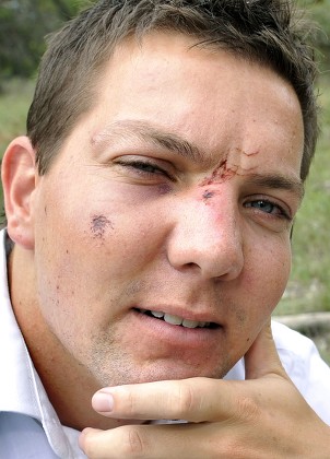 David Striegl Poses His Facial Injuries Editorial Stock Photo - Stock ...