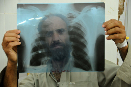 Patient Suffering Tuberculosis Tb Looks His Editorial Stock Photo ...
