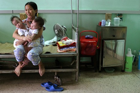 Tenmonthold Conjoined Twins Le Thu Cuc Editorial Stock Photo - Stock ...