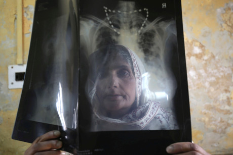 Elderly Woman Suffering Tuberculosis Tb Checks Editorial Stock Photo ...