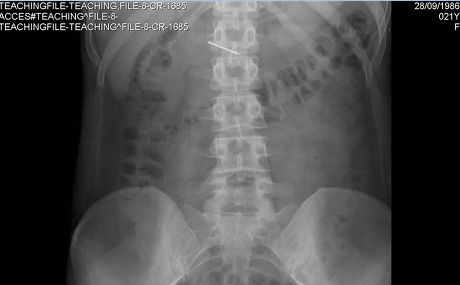 Xray Showing Nail Editorial Stock Photo - Stock Image | Shutterstock