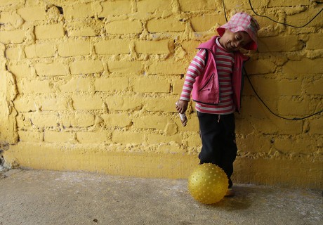 72 Progeria Stock Pictures, Editorial Images and Stock Photos ...