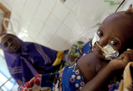 Child Suffering Severe Malnutrition Pictured Pedeatric - Foto de stock ...