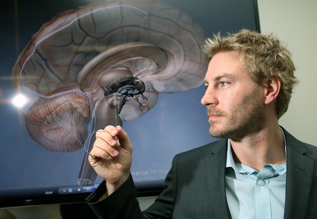 Dr Nicholas Opie Holds Stentbased Electrode Editorial Stock Photo ...