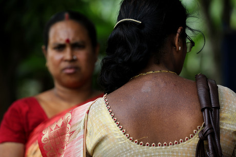 Indian Villagers Arsenic Poisoning Victims Show Editorial Stock Photo ...