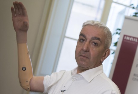 One Prototypes Polyarticulate Prosthetic Hand Hannes Editorial Stock ...