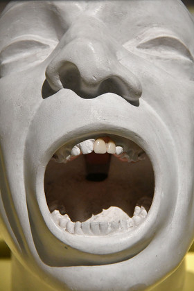 Model Cleft Palate Prosthesis 191040 Editorial Stock Photo - Stock ...