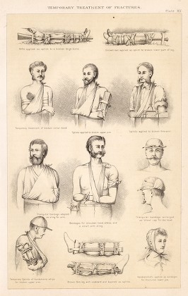 Temporary Treatment Bone Fractures Including Rifle Editorial Stock ...