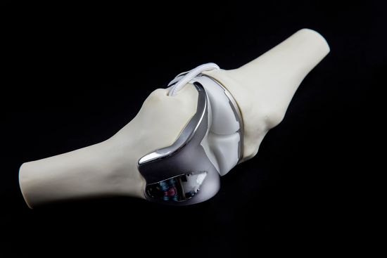Knee Prosthesis Knee Endoprosthesis Knee Joint - Foto de stock de ...