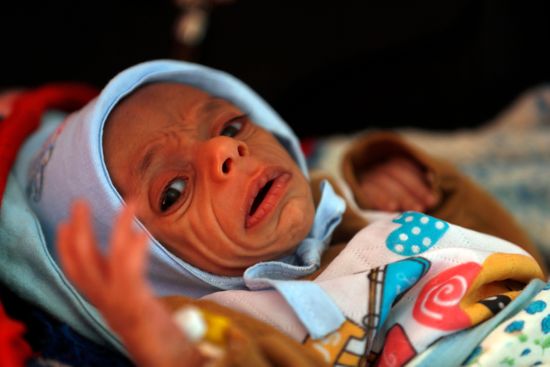 Malnourished Child Gets Medical Attention Unsupported Editorial Stock ...