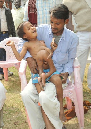 Eight Limbed Boy Deepak Kumar Father Editorial Stock Photo - Stock ...