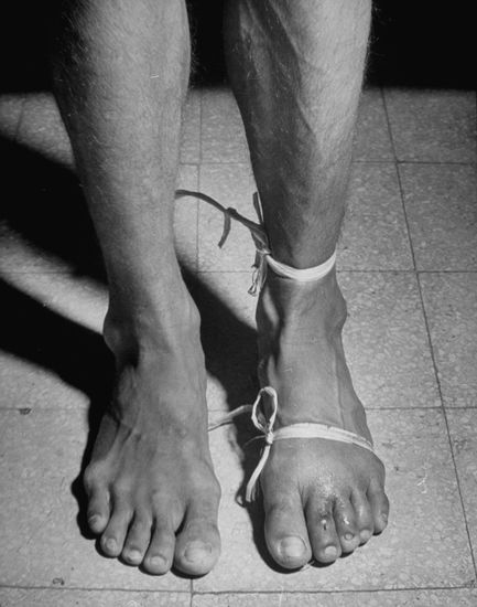 Snake Bite Victim Having Wound Treated Editorial Stock Photo - Stock ...