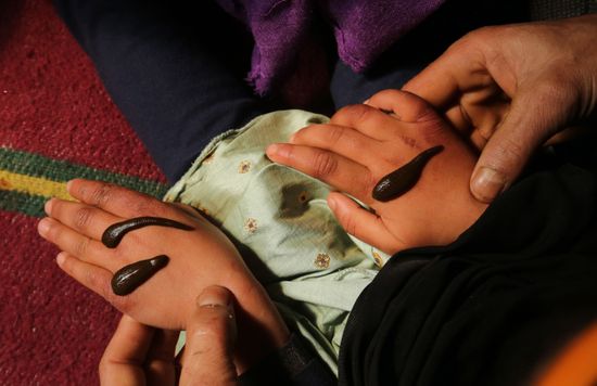 Leeches Placed By Local Practitioner On Editorial Stock Photo - Stock ...